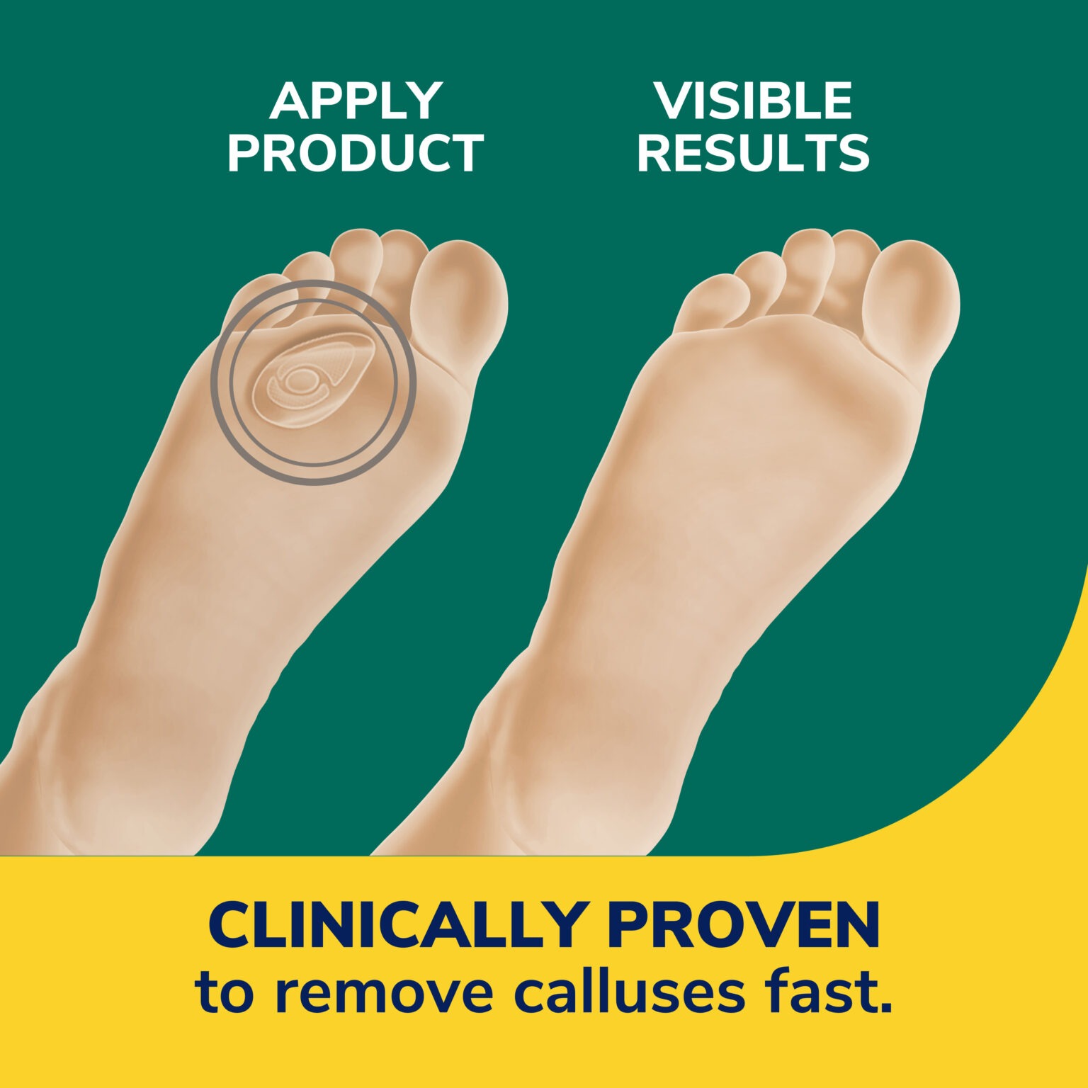 Callus Remover Seal & Heal Bandage with Hydrogel™ Technology Dr. Scholl's